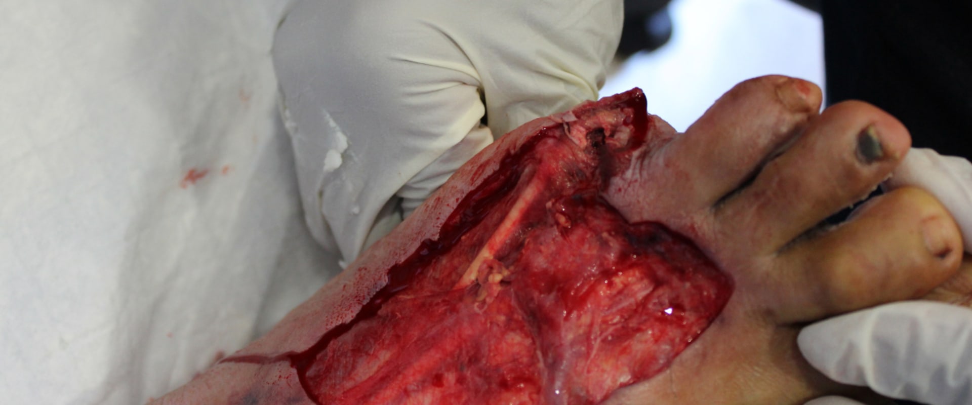 The Importance of Moist Wound Treatment for Faster Healing