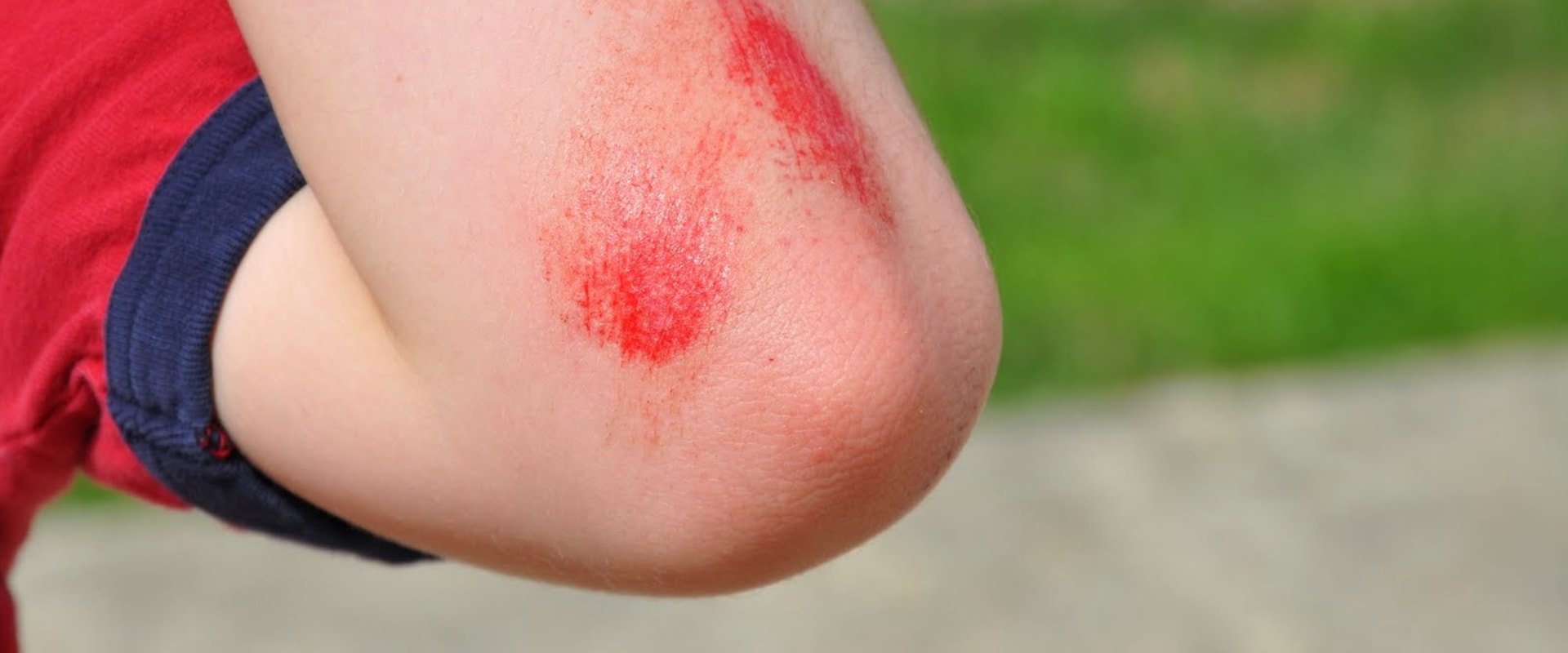 Is Your Cut Infected? What an Infected Cut Looks Like & How to Treat It ...