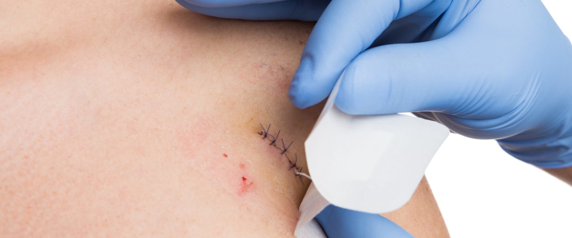 Understanding Healing: What Do Dissolvable Stitches Look Like in ...