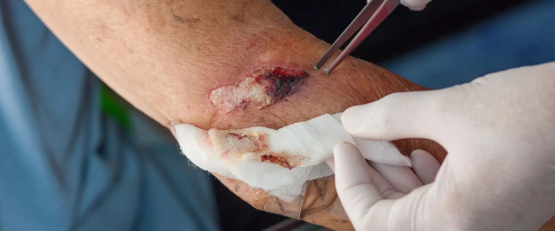 Purulent Wound Drainage or Normal Fluid? Spot the Difference