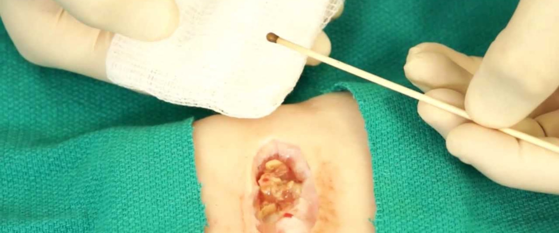 The Benefits Of Using Silver Nitrate On Skin Wounds In Emergency Situations