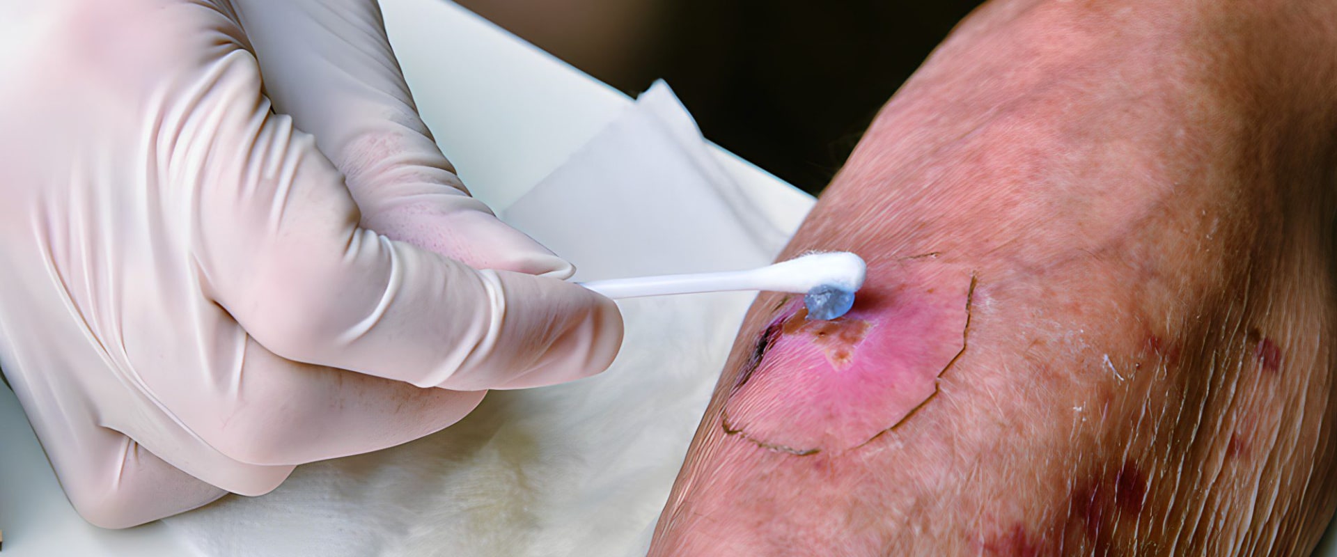 How to Address Slow Healing Wounds With Emergency Wound Care Techniques