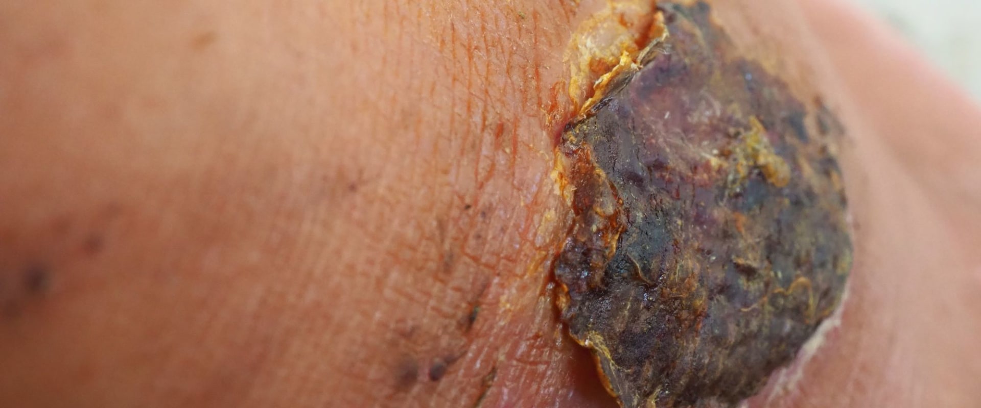 The Truth About Wound Healing: Covered or Uncovered?