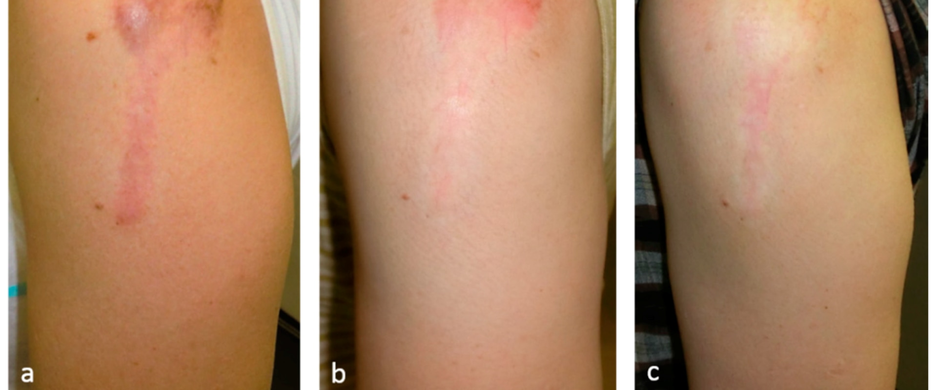 Step-by-Step Guide to Hypertrophic Scar Healing Stages in Emergency ...