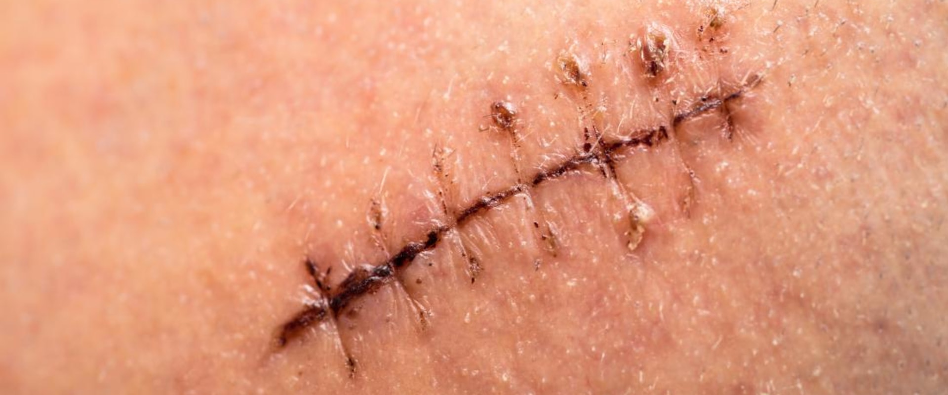 How Long Do Dissolvable Stitches Last? What You Need to Know for the ...