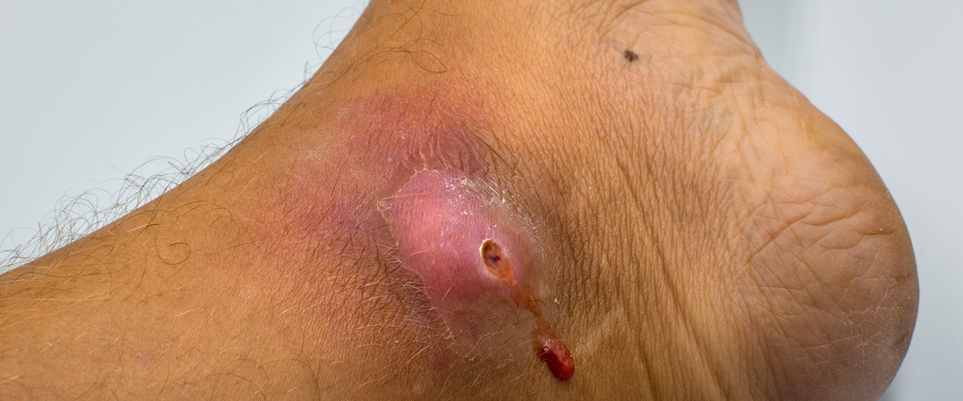 The Best and Worst Ways to Treat Open Wounds