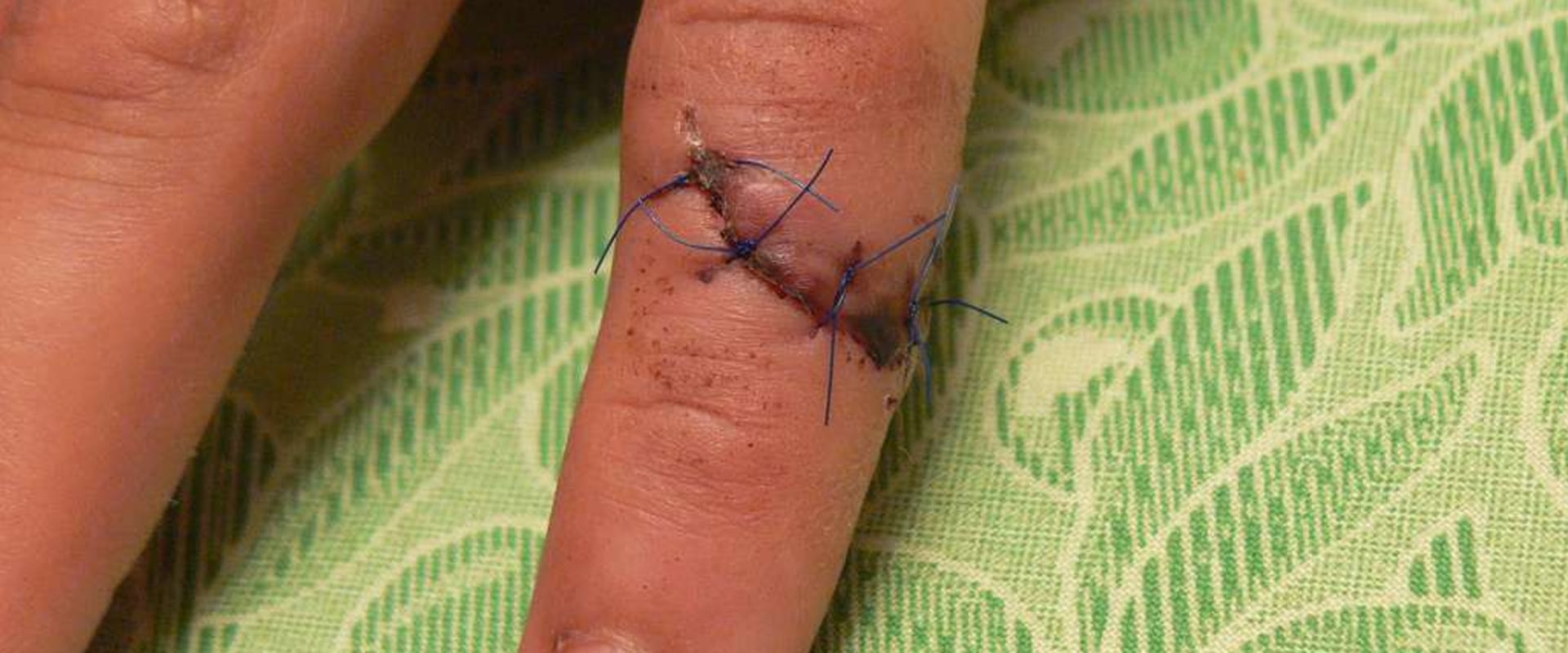 Navigating What Do Dissolvable Stitches Healing Stages Look Like During ...