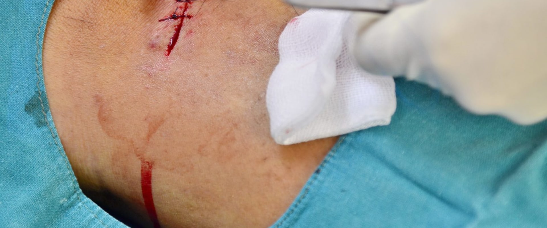 Infected Stitches Warning Signs? Heal Faster With Proven Tips