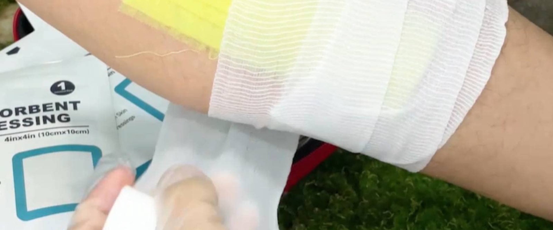 Adaptic vs Xeroform: Best for Burns and Surgical Wounds?