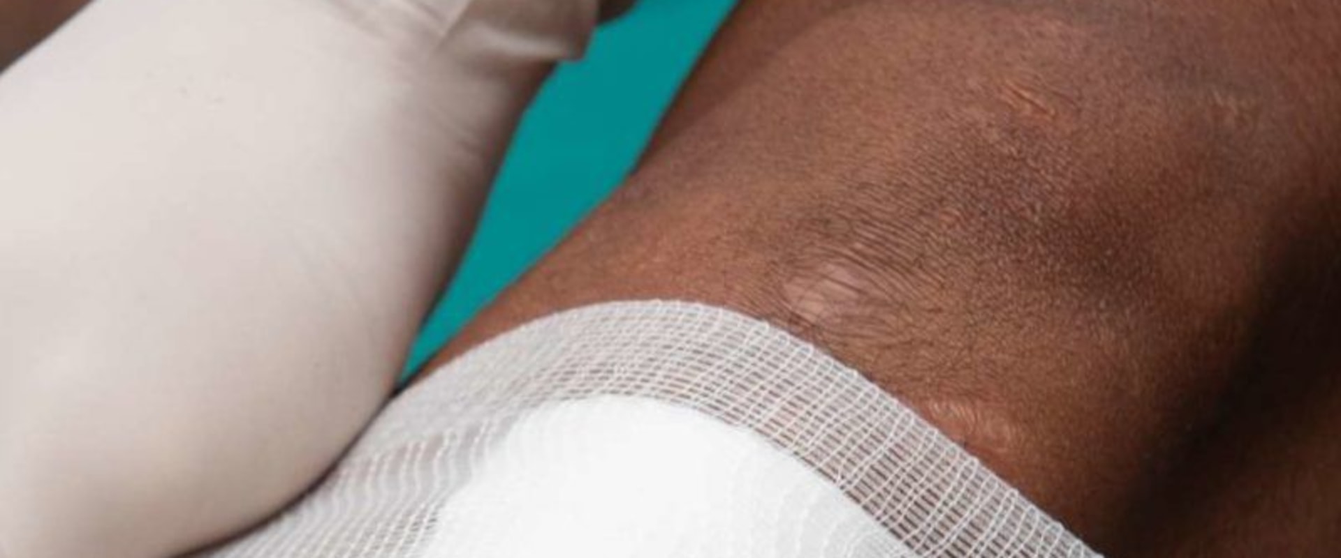 The Truth About Wound Care: To Cover or Not to Cover?
